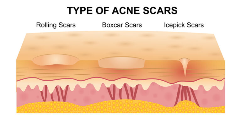 Acne Scars Treatment Brisbane | Laser and Skin Clinic