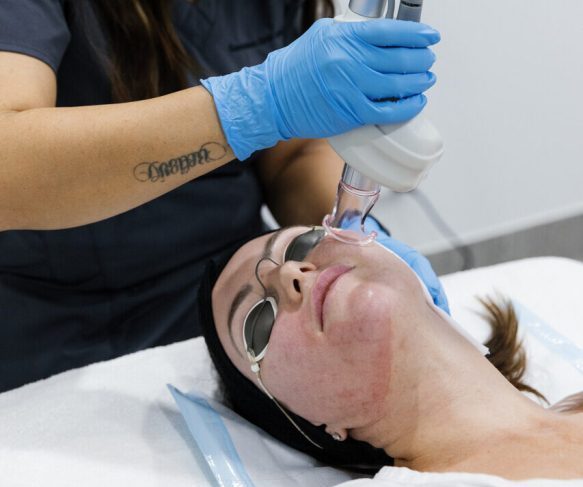 CO2 Laser Resurfacing Brisbane