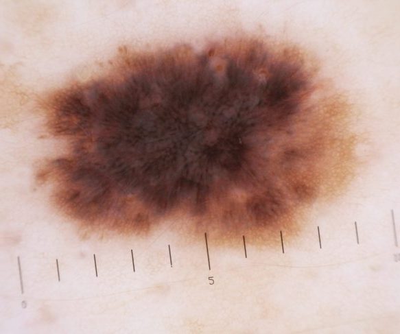 Dysplastic Naevi & Mole Removal | Brisbane